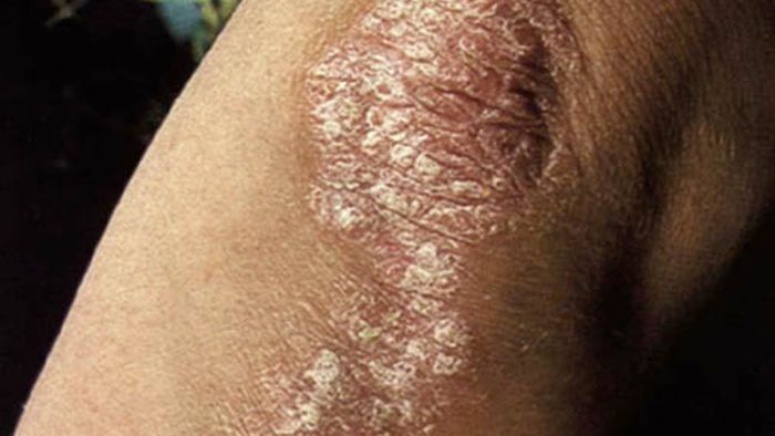 Psoriasi malattia trasmissibile grave In Italia colpisce tre milioni di ...